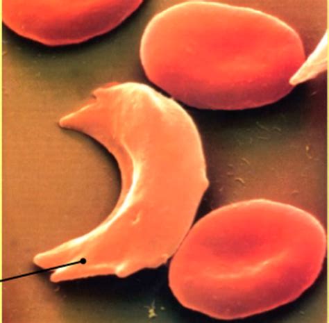Tenth Grade Lesson Detecting Genetic Variation Sickle Cell Trait