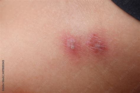Shingles Disease Herpes Zoster Varicella Zoster Virus Skin Rash