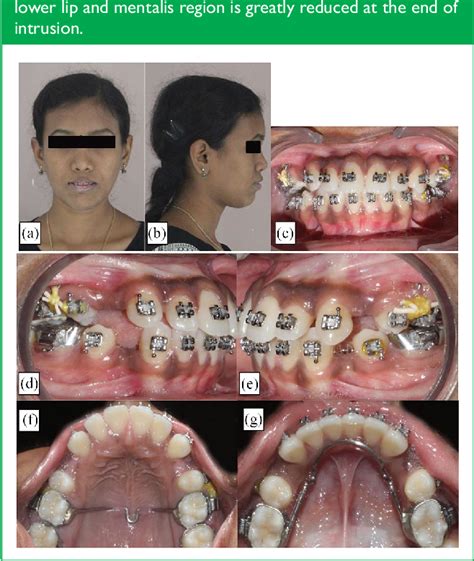 Figure 3 From Intrusion Of The Maxillary Posterior Teeth With A Single