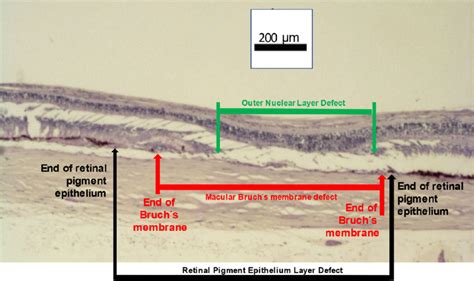 Microphotograph Showing A Bruchs Membrane Defect Surrounded By A Download Scientific Diagram