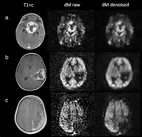 Clinical Examples Of Implementation Of The Denoising Autoencoder Dae