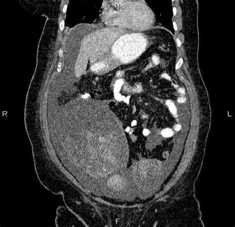 Krukenberg Tumour Pacs
