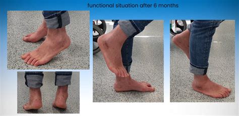 Calcaneal Fracture Comminuted Minimal Invasive Treatment Of Calcaneal