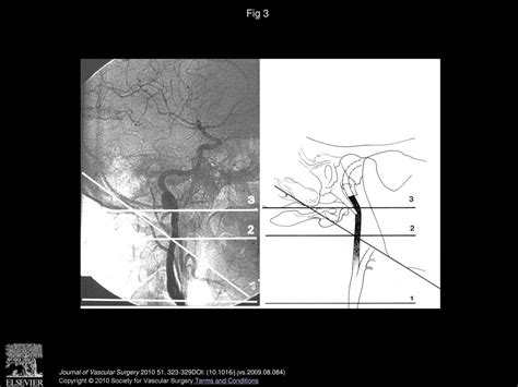 Open Surgical Reconstruction Of The Internal Carotid Artery Aneurysm At