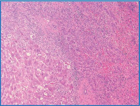 47 Acute Viral Hepatitis Abdominal Key