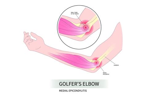 Golfing With Golfers Elbow An Expert Perspective On What It Is And How