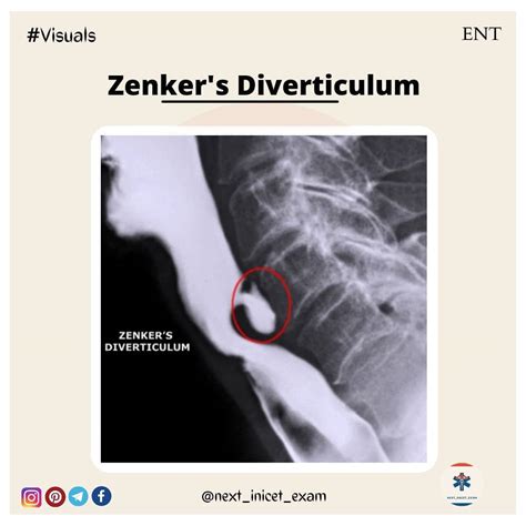 Next Inicet Exam Zenkers Diverticulum Is A Type Of Diverticulum That Develops In The