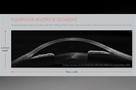 Optovue Solix Oct Angiography Saturn Optical