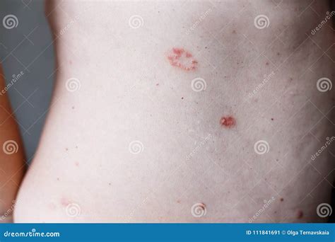 Psoriasis Skin Psoriasis Is An Autoimmune Disease That Affects The Skin Cause Skin Inflammation