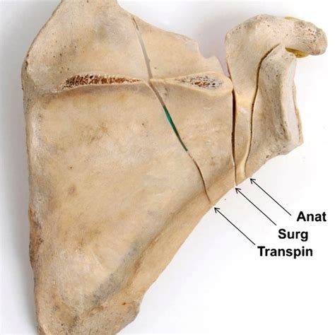 Pdf Fractures Of The Scapular Neck Diagnosis Classifications And Treatment