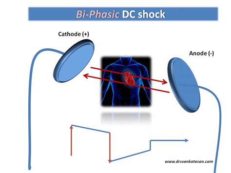 Monophasic Vs Biphasic Dc Shock Dr S Venkatesan Md