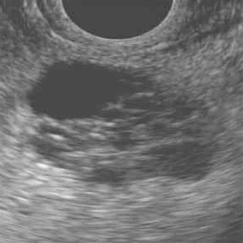 Incidental Pancreatic Cyst Management Algorithm Download Scientific