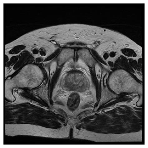 Computed Tomography Scan Showing Prostatic Bed Haematoma Download Scientific Diagram