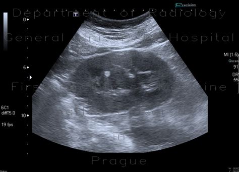 Angiomyolipoma Ultrasound