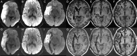 Virtual Reality Assessment For Visuospatial Neglect Importance Of A Dynamic Task Journal Of
