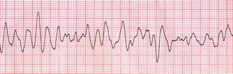 Topic Using The Algorithm For Cardiac Arrest For Shockable Rhythms Vf And Pvt Acls Ep