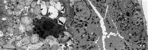 Electrone Microscope A Csa Group Tubular Epithelial Cell Oedema Of