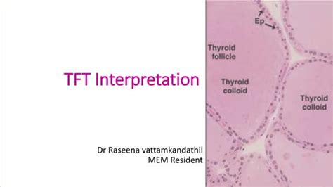 Tft Interpretation Tsh T4 T3 Tpo Antibodiespptx Thyroid Disorders Endocrine And Tft Interpretation Tsh T4 T3 Tpo Antibodiespptx Thyroid Disorders Endocrine And