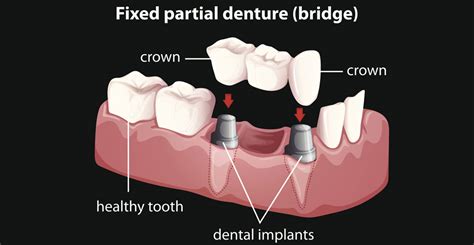Fixed Hybrid Overdentures Knoxville Tn Prosthetic Teeth