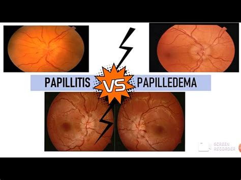 Normal Retina Vs Papilledema