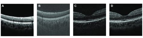 Examples Of The Original Oct Images From A Costa H Dataset B