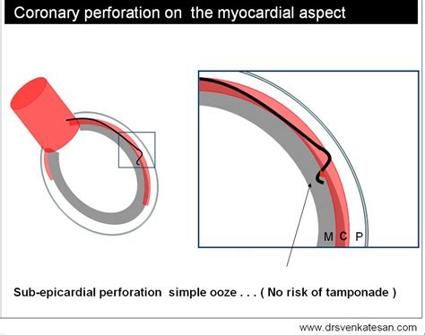 Ellis Classification Of Coronary Perforation Drsvenkatesan Md