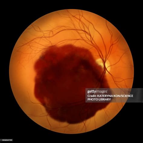 Subretinal Haemorrhage Illustration High Res Vector Graphic Getty Images