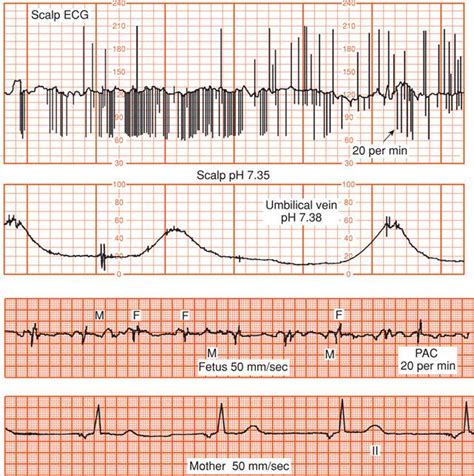 Umbilical Cord Compression Fetal Heart Tracing