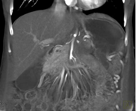 Adenocarcinoma Body Of Pancreas With Vascular Encasement And Occlusion
