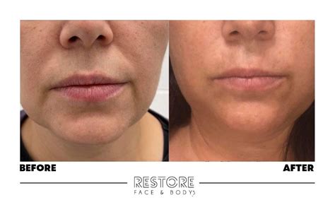 Hifu Before And After Treatment — Restore Face And Body 4d Hifu