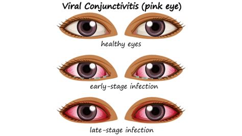 Conjunctivitis Symptoms Causes Preventions