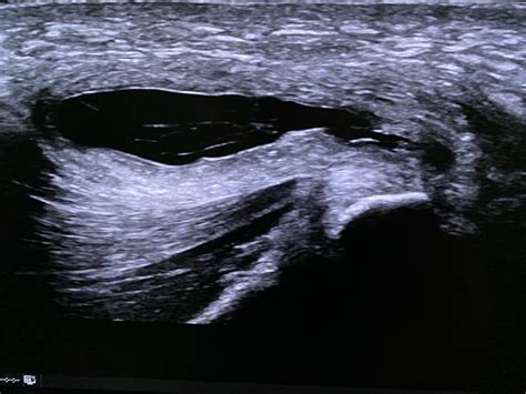 Ischial Bursitis