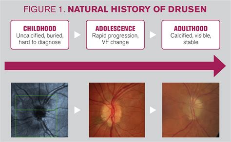 Imaging To Differentiate Disc Drusen From Papilledema