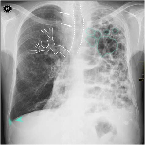 Emphysema Chest X Ray Captions Watch