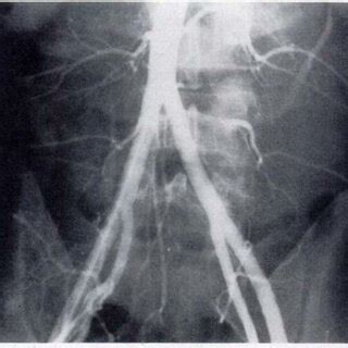 Bone Island Lateral Radiograph Shows Bone Island With Ill Defined Download Scientific Diagram