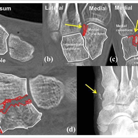 A Single Type 2 Volar Compressive Intermediate Cuneiform Fracture With Download Scientific