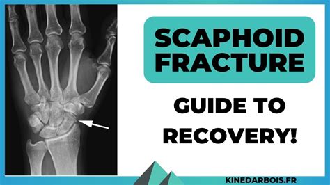 What Is The Recovery Time For A Scaphoid Fracture