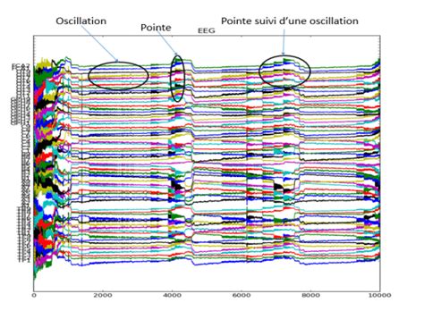 Eeg Signal Of A Coupled Epileptic Network Simulation Depicting Three