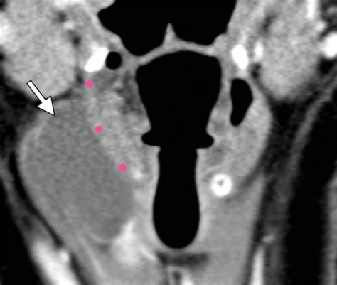 Ectopic Thyroid Endocrinesurgerynetau