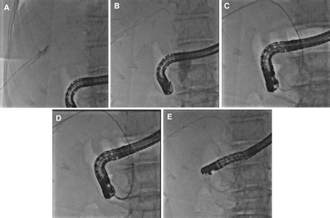 Percutaneous Transhepatic Endoscopic Rendezvous Procedure In A Patient Download Scientific