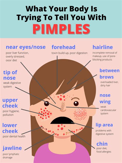 How To Properly Pop Pimples 3 Don Ts And 3 Steps To Get Rid Of Pimples