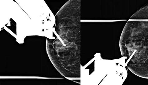 How To Perform Stereotactic Mammographic Guided Biopsy Radiology Ucla Health
