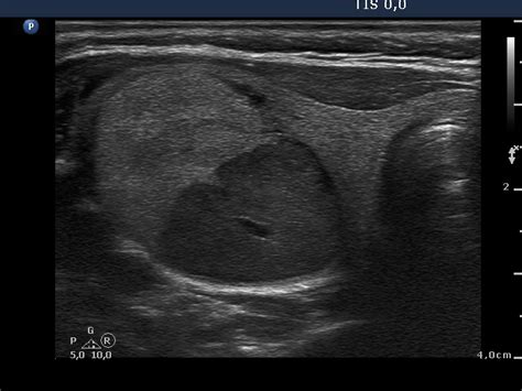 The Echogenicity Of The Nodule