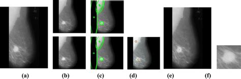 Mass Detection Steps A Original Mammogram Image B Pre Processing