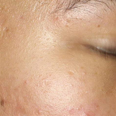 Acnee Object Detection Dataset And Pre Trained Model By Skripsi Bismillah