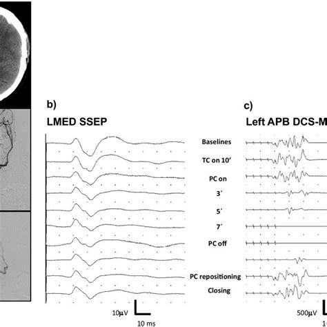 Central Sulcus Mapping By Ssep Phase Reversal Technique Ssep Phase Download Scientific Diagram