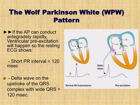 Asymptomatic Wpw Management Ppt Heart And Cardiovascular Diseases Diseases And Conditions