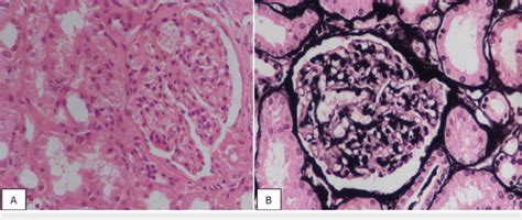 Class Ii Lupus Nephritis A Hematoxylin And Eosin Staining At ×400 Download Scientific