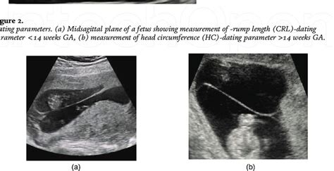 Assessment Of Chorionicity A Lambda Sign Dcda Twins B T Sign Mcda