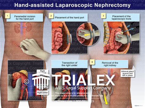 Hand Assisted Laparoscopic Nephrectomy Trialexhibits Inc